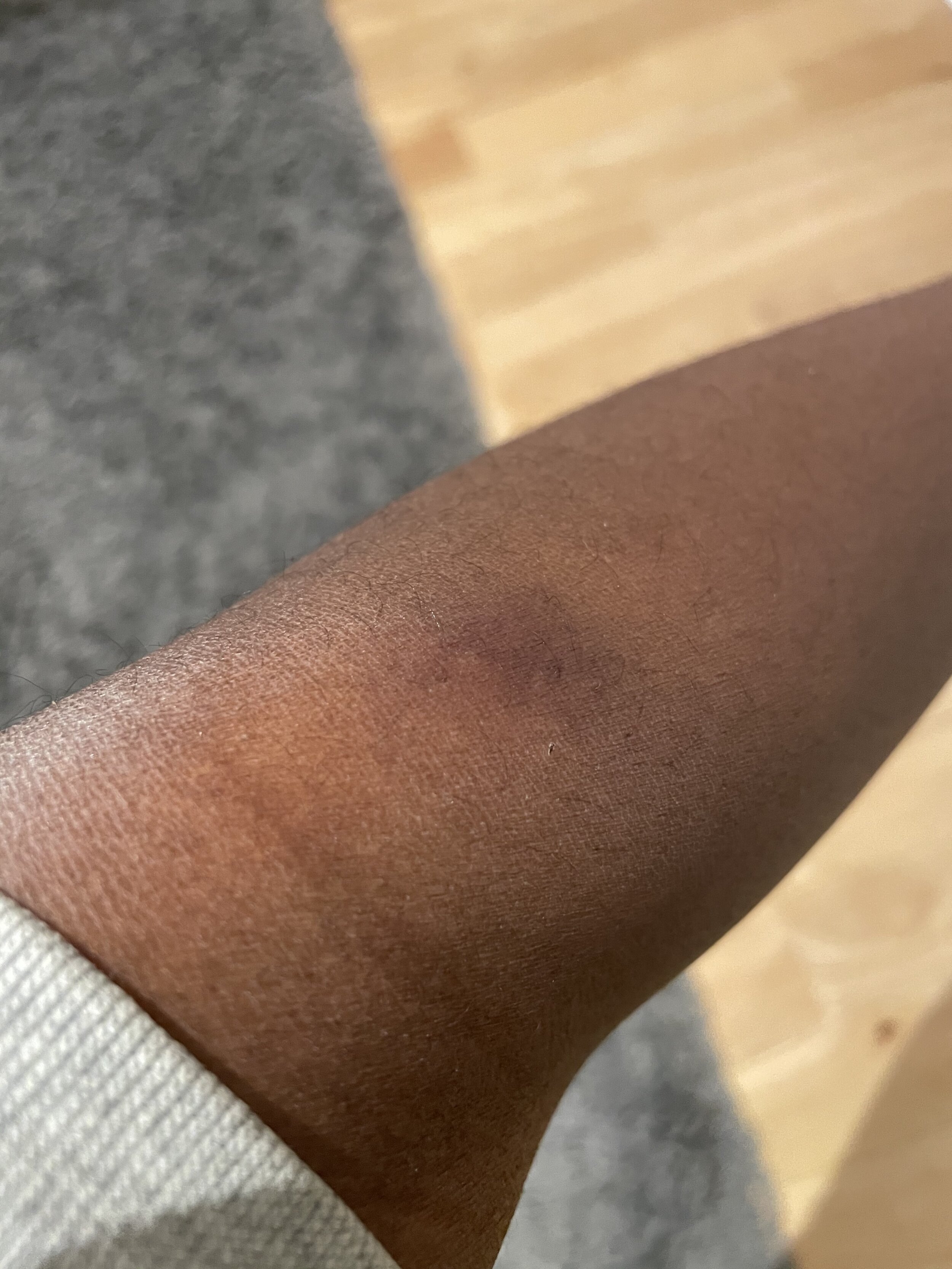 Bruise — Black And Brown Skin
