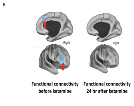 Episode 137: Ketamine Update with Brandon Kitay, M.D. — Psychiatry ...