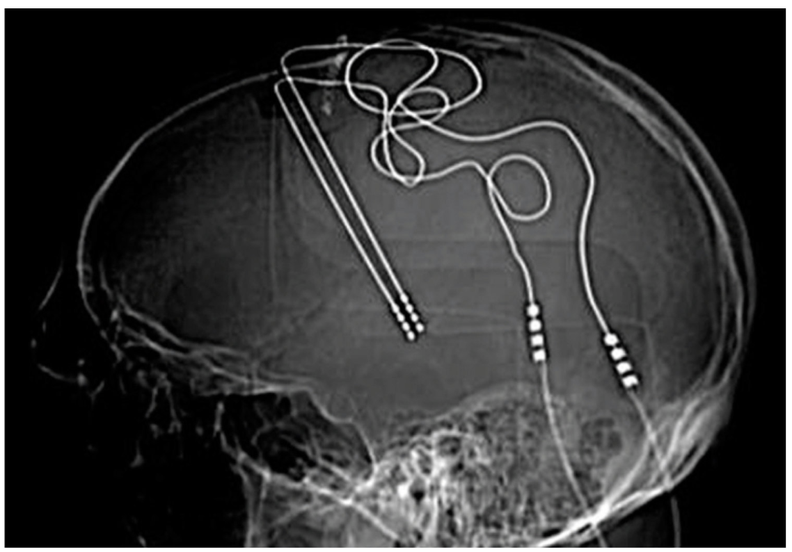 Episode 056: Is Elon Musk’s Neuralink a Science Fiction Horror Show or ...