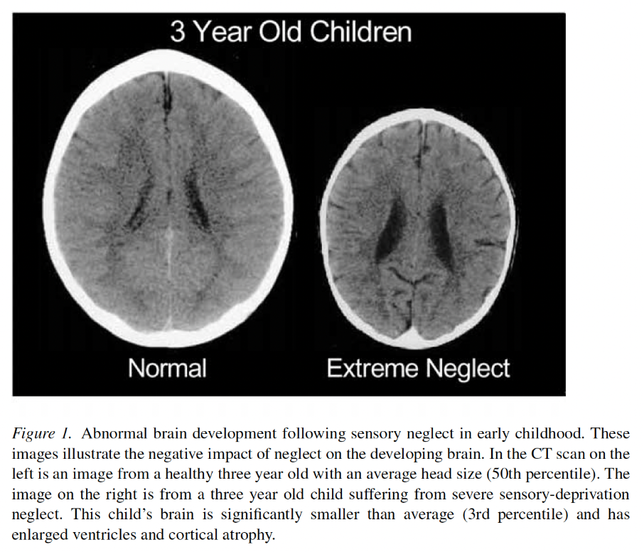 Episode 217: Adverse Childhood Experiences - HPA axis & Brain changes ...