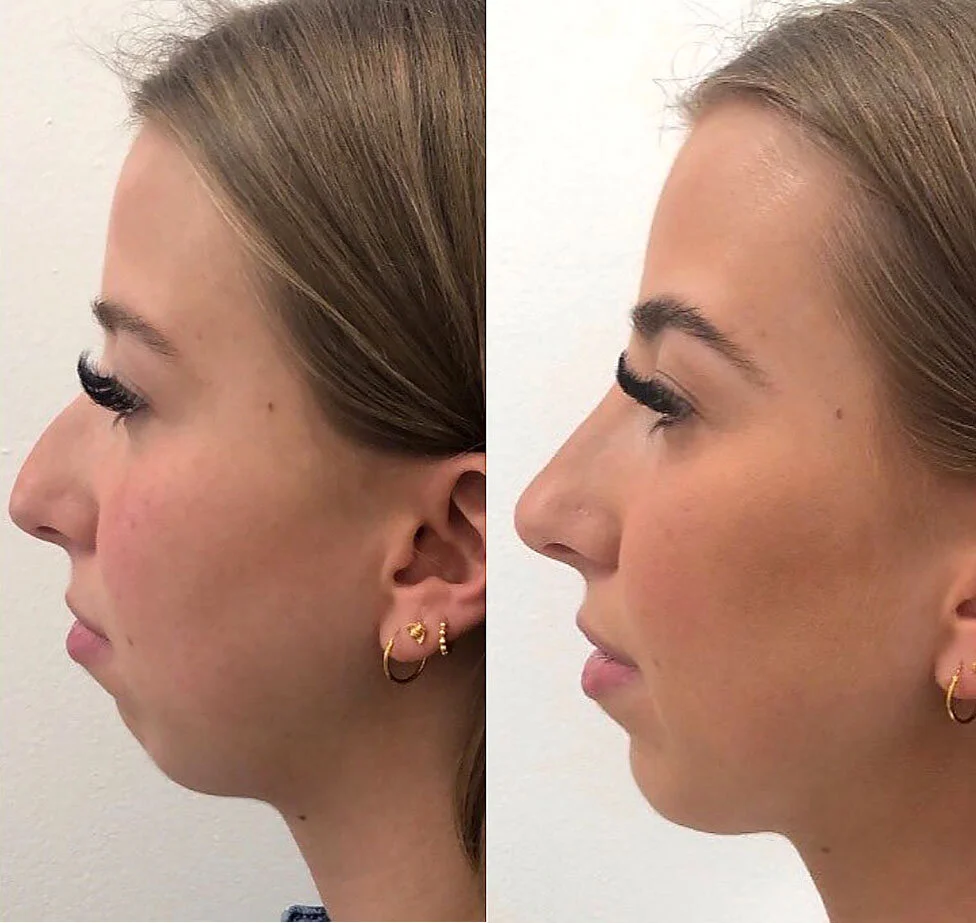 Dermal Fillers Brisbane | Cosmetic Filler Treatment | Sonder Private ...