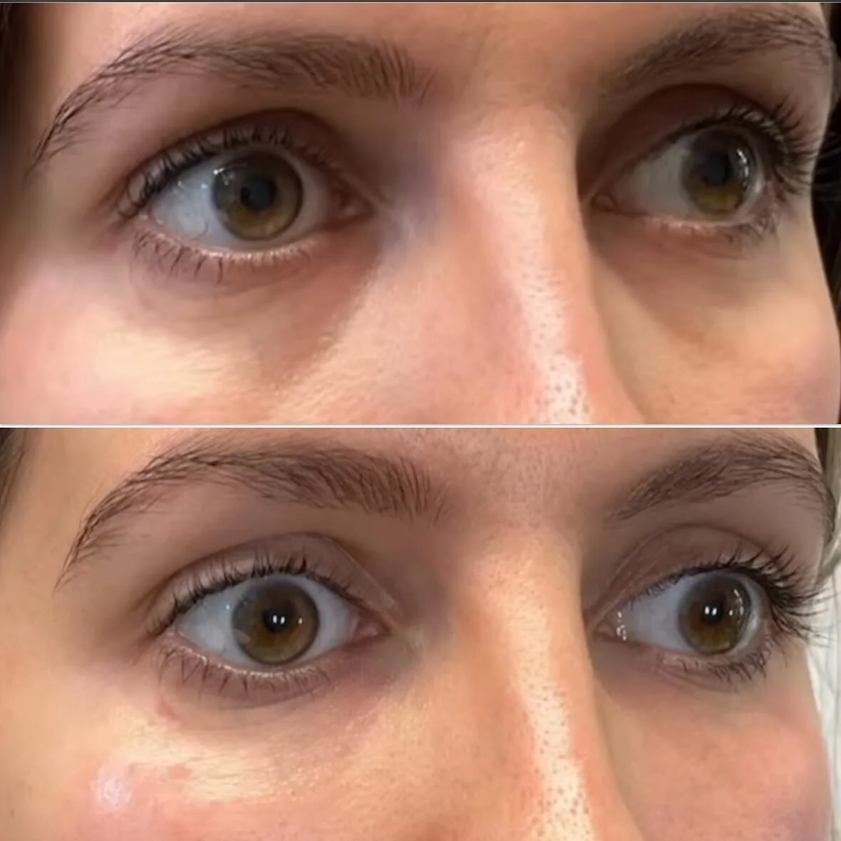 PDO Mono Thread Treatment Brisbane | Sonder Private Clinic