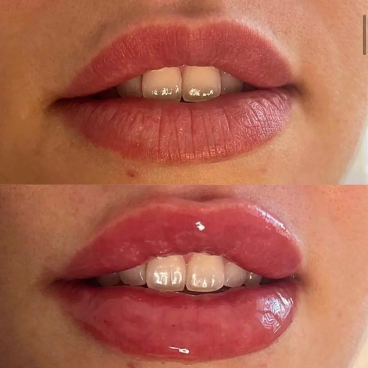 PDO Mono Thread Treatment Brisbane | Sonder Private Clinic