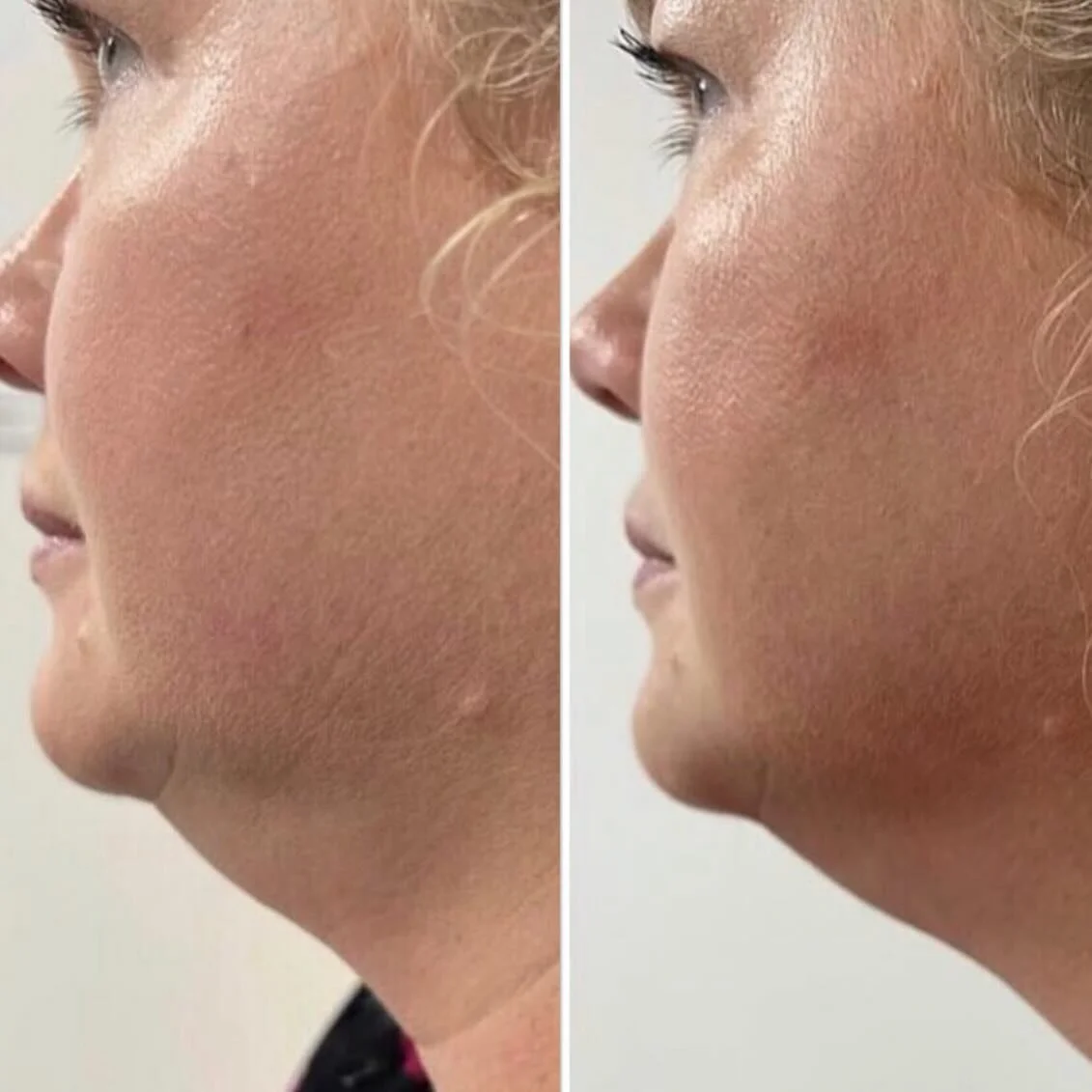 Bio-Remodelling Treatment Brisbane