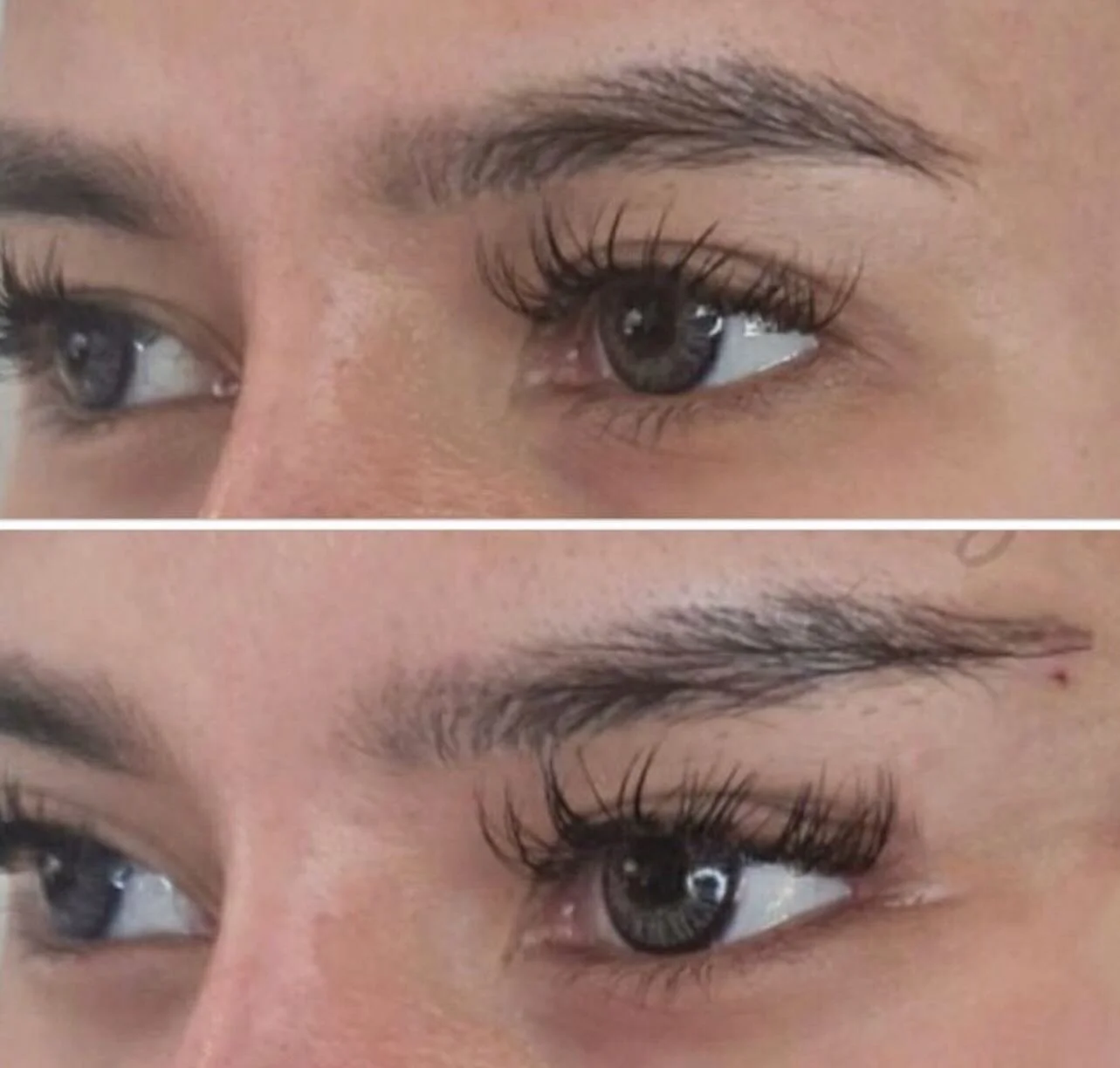 PDO Mono Thread Treatment Brisbane | Sonder Private Clinic