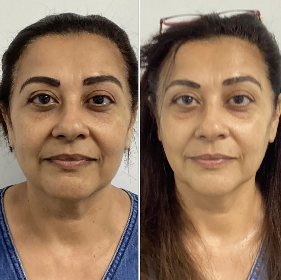 HIFU Body Contouring