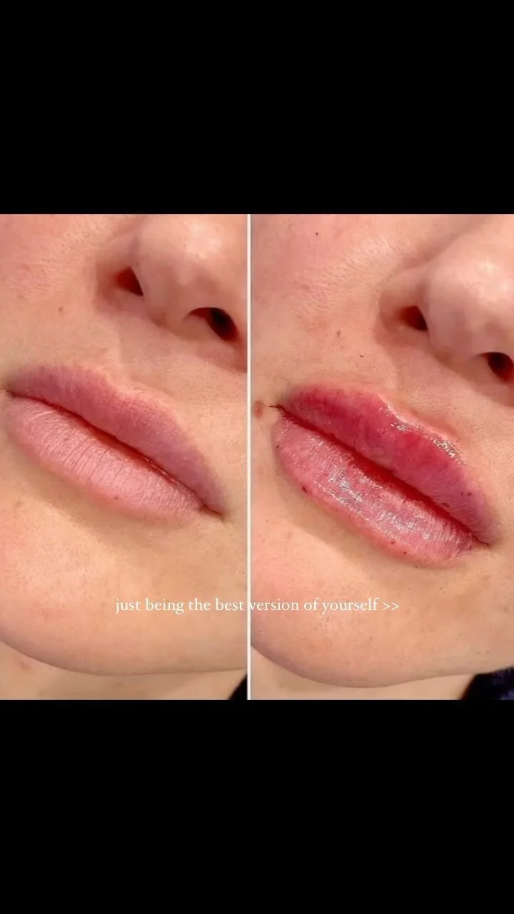 HIFU Body Contouring