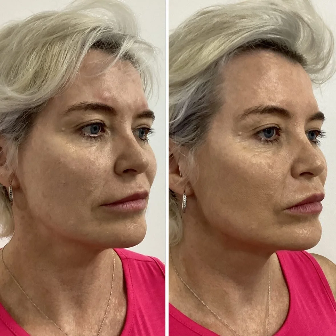 HIFU Body Contouring