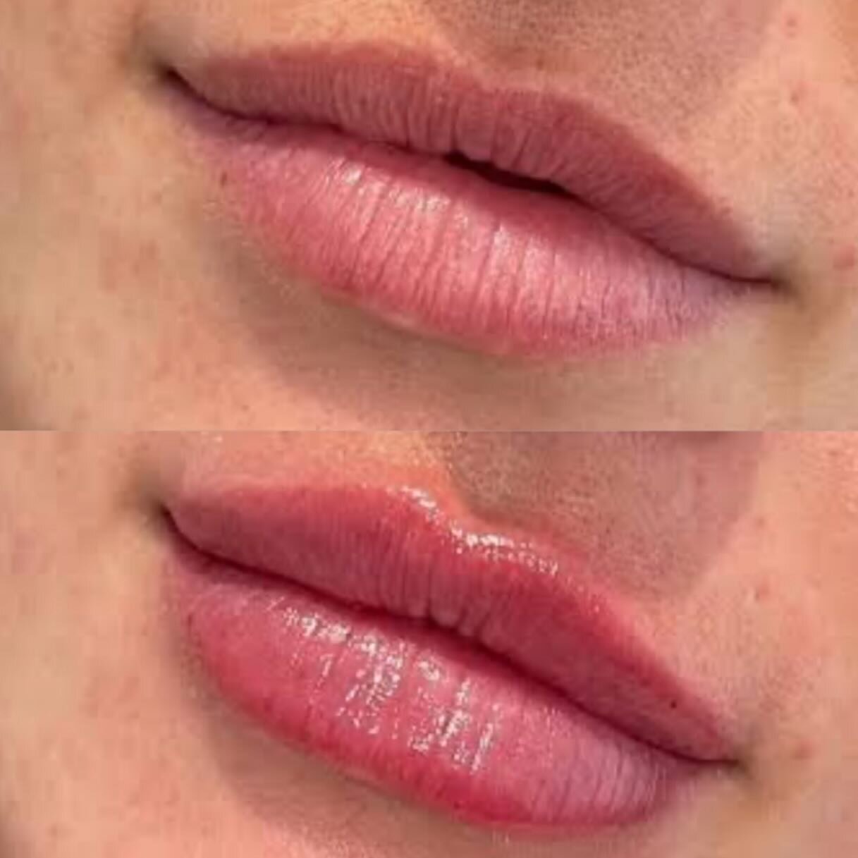 HIFU Body Contouring