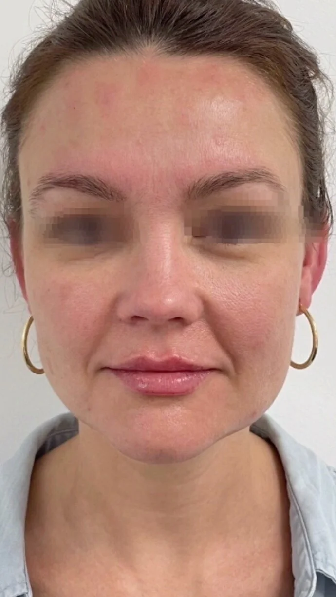 Dermal Fillers Brisbane | Cosmetic Filler Treatment | Sonder Private ...