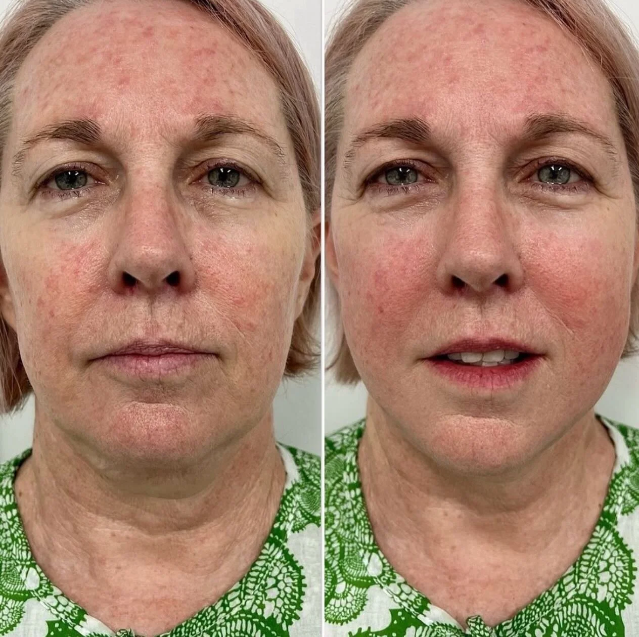 Dermal Fillers Brisbane | Cosmetic Filler Treatment | Sonder Private ...