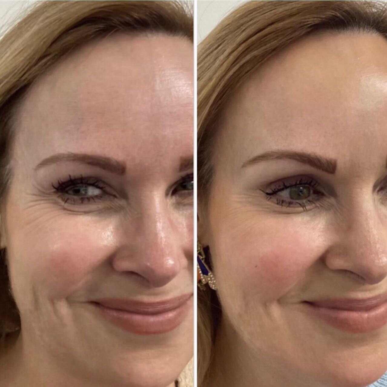 Dermal Fillers Brisbane | Cosmetic Filler Treatment | Sonder Private ...