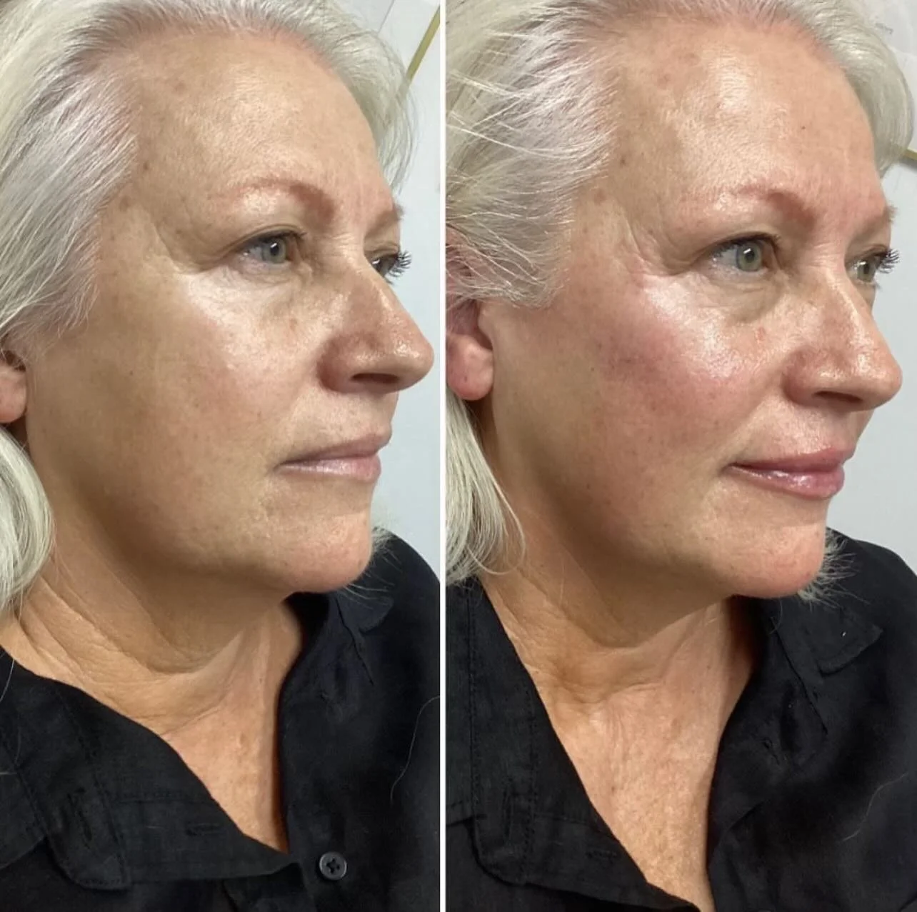 PDO Mono Thread Treatment Brisbane | Sonder Private Clinic