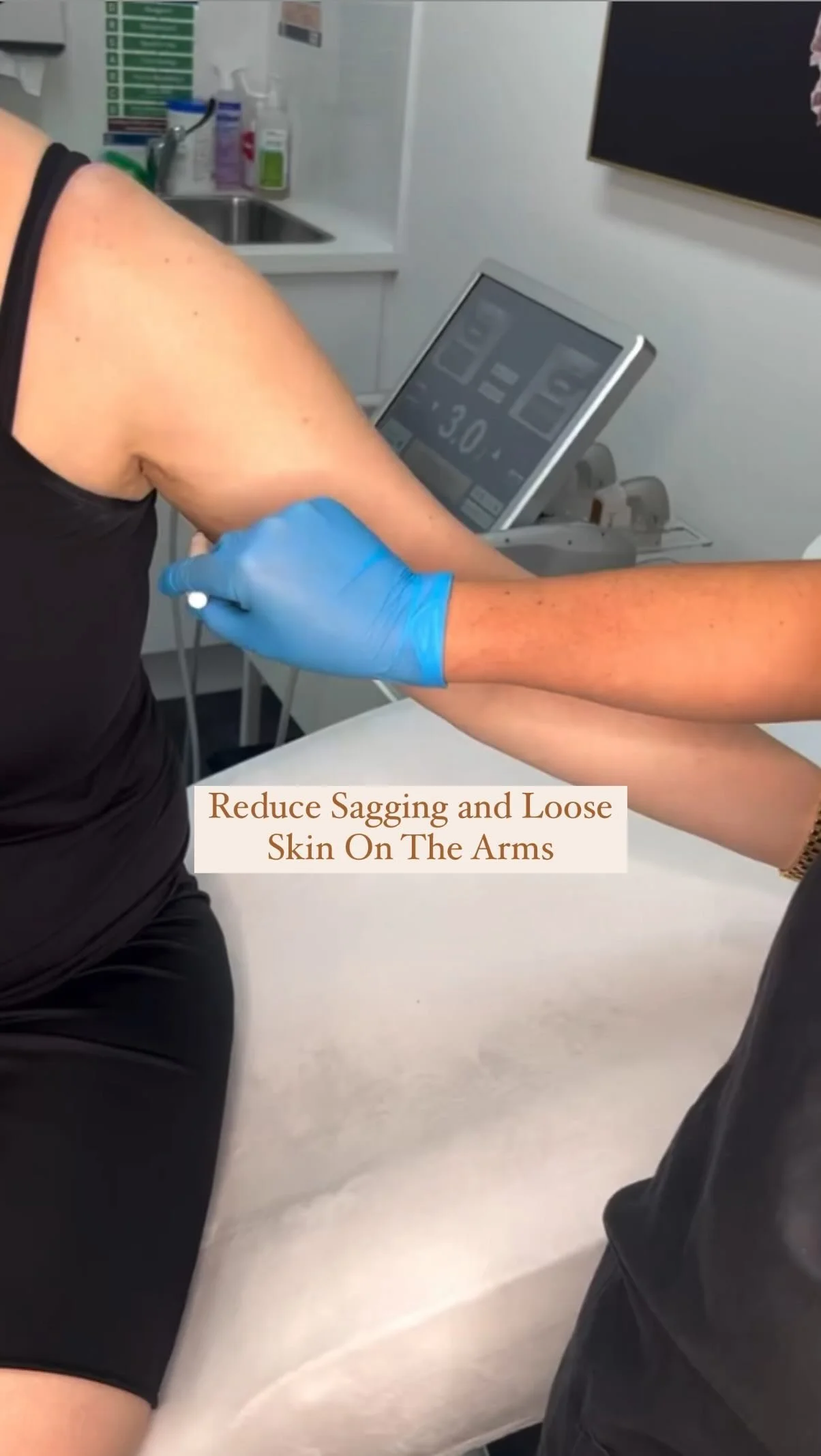 PDO Mono Thread Treatment Brisbane | Sonder Private Clinic