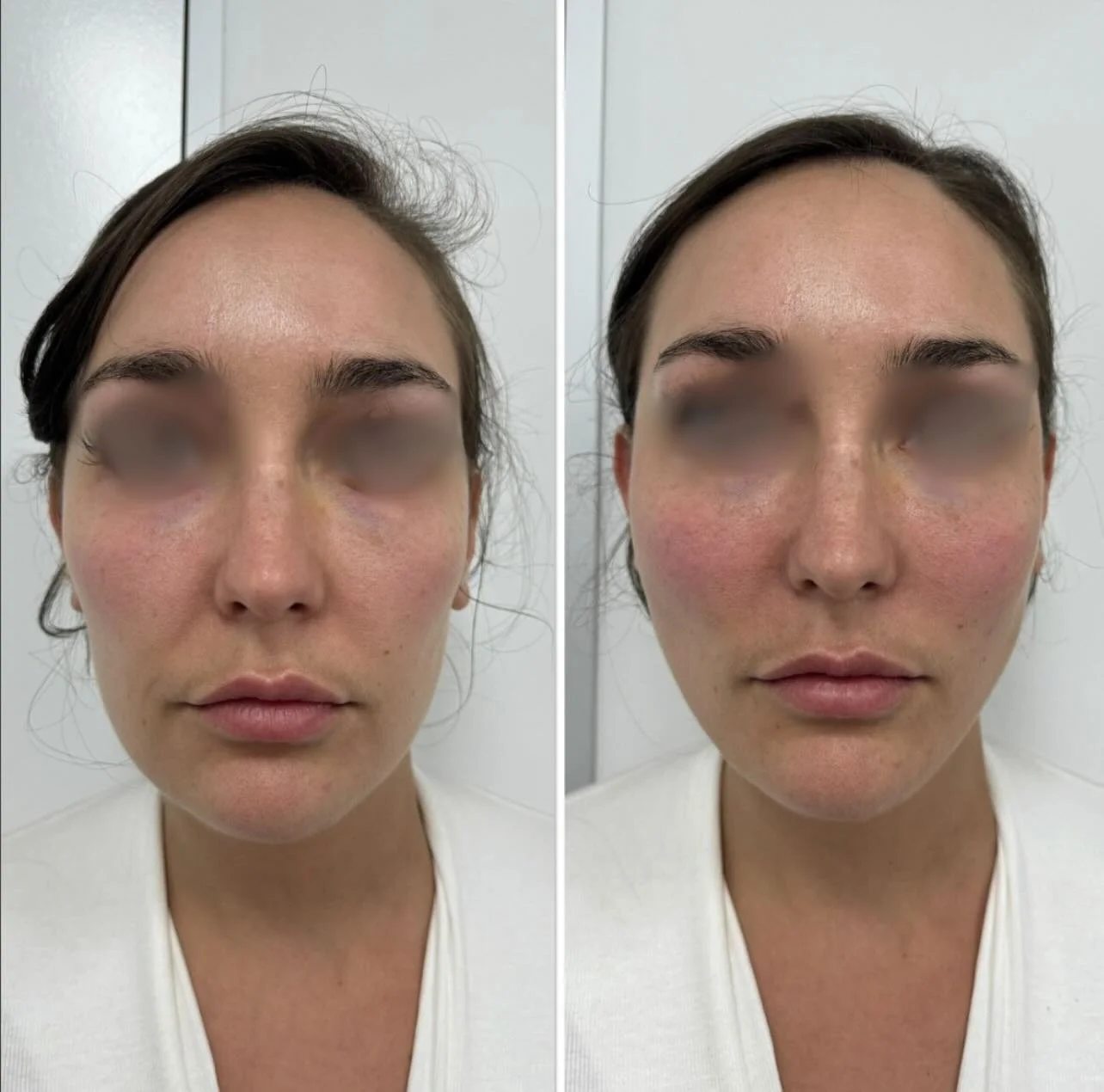 PDO Mono Thread Treatment Brisbane | Sonder Private Clinic