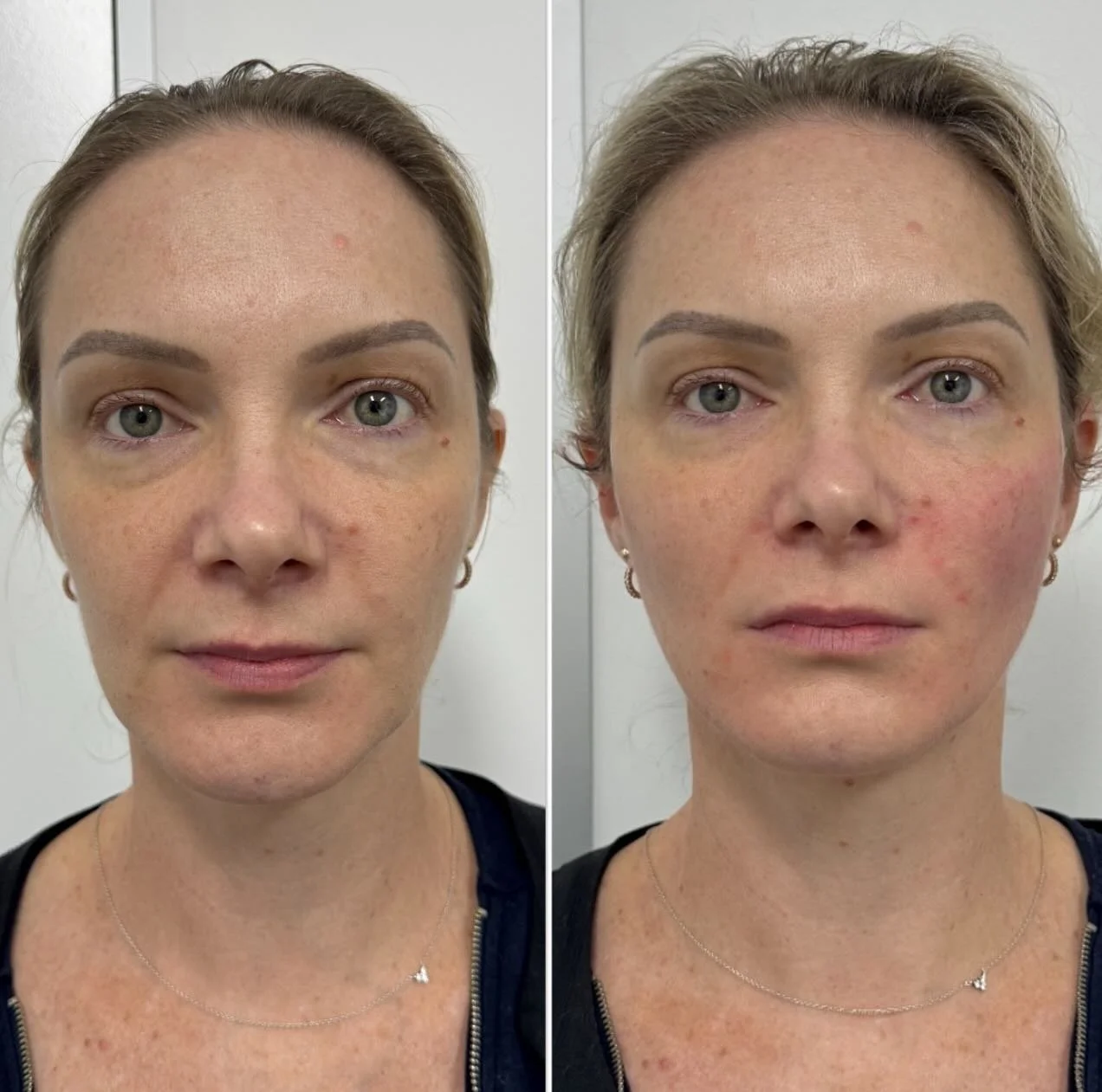 PDO Mono Thread Treatment Brisbane | Sonder Private Clinic