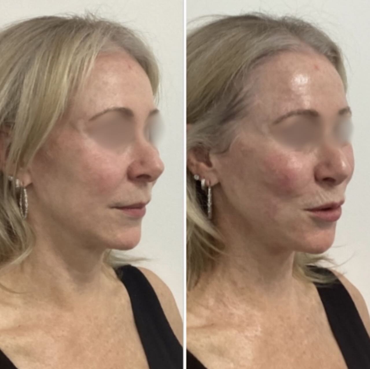 Dermal Fillers Brisbane | Cosmetic Filler Treatment | Sonder Private ...