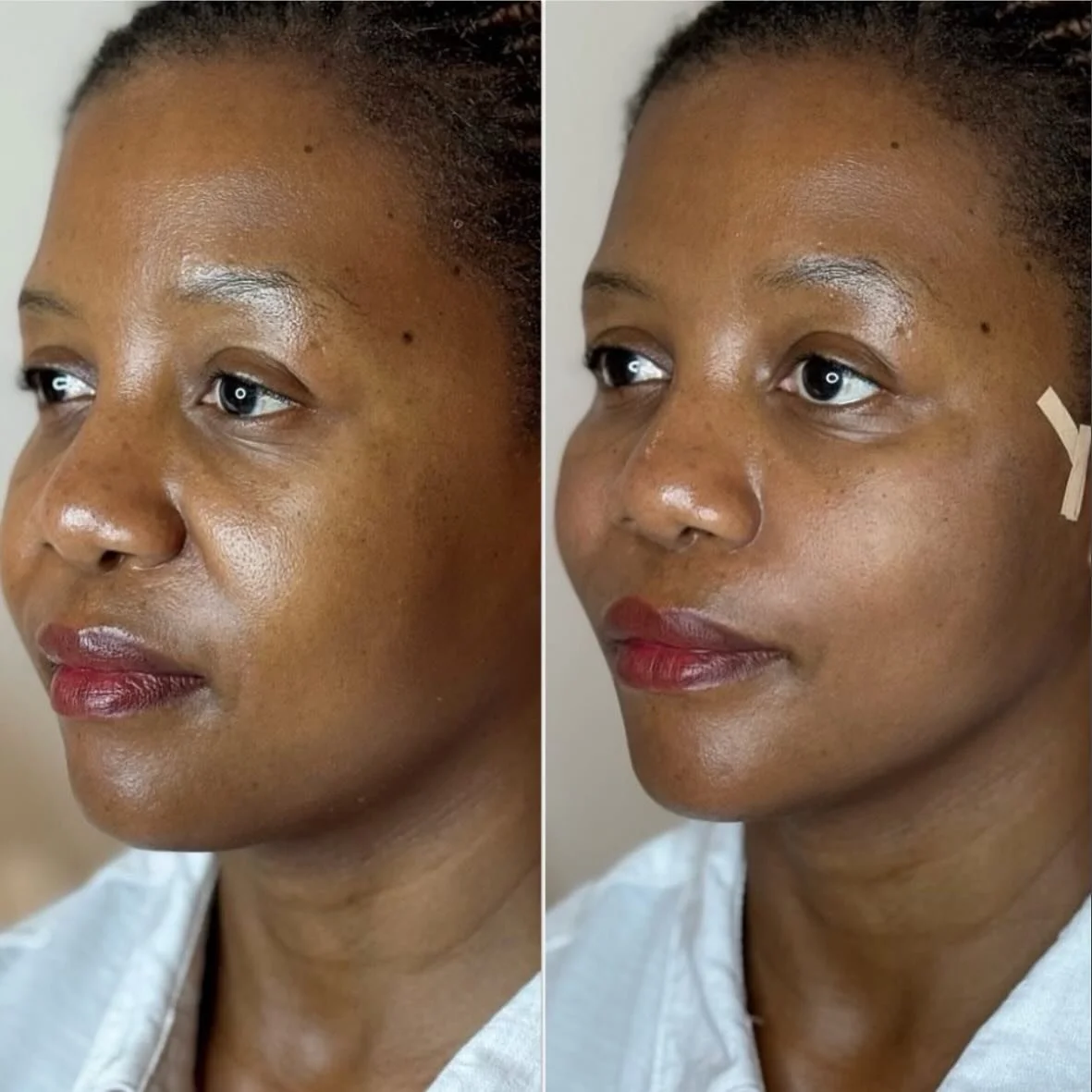 Bio-Remodelling Treatment Brisbane