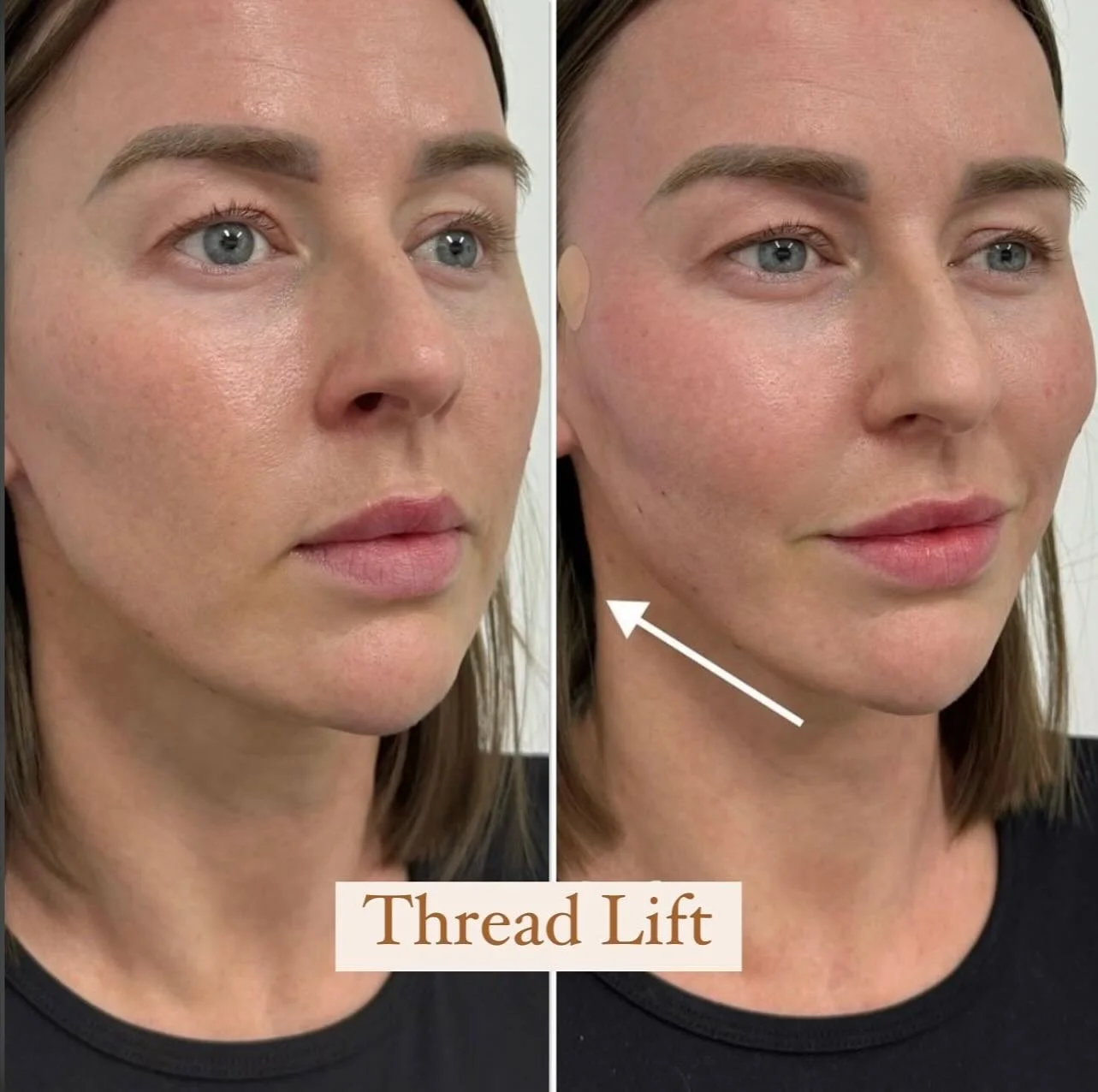 IV Vitamin Therapy | Vitamin Infusion Treatment Brisbane - Sonder ...