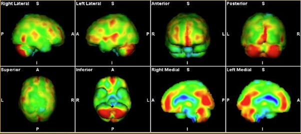 The Medical Use of Cannabis to Treat ADHD - an Australian Case Study ...