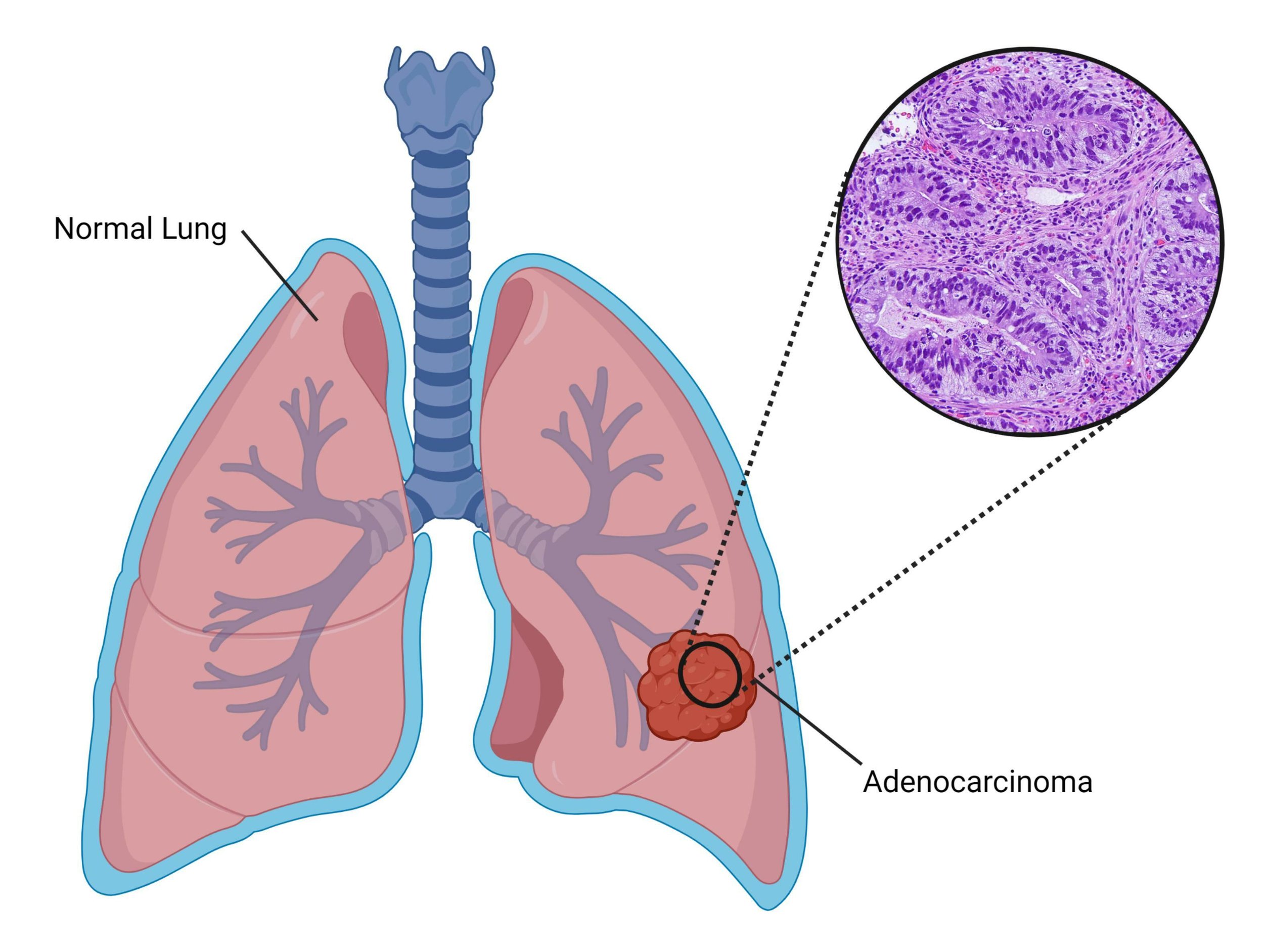 What Is Indolent Adenocarcinoma – SDYEM