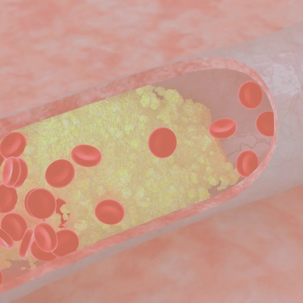 How I Lowered My High Cholesterol Without Meds - 10 Key Factors Your ...