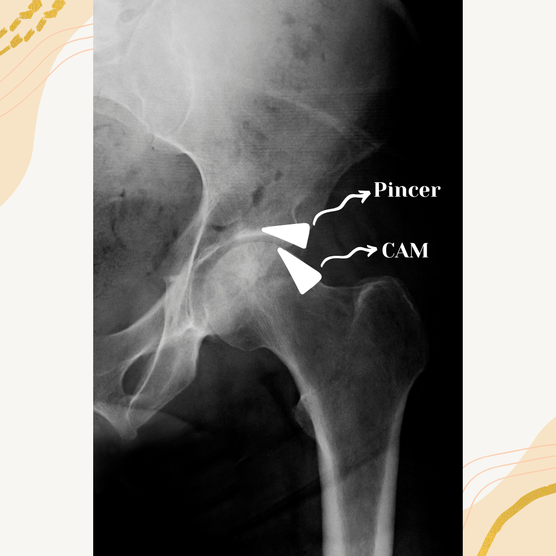 Understanding Femoroacetabular Impingement (FAI): Causes, Symptoms, and ...