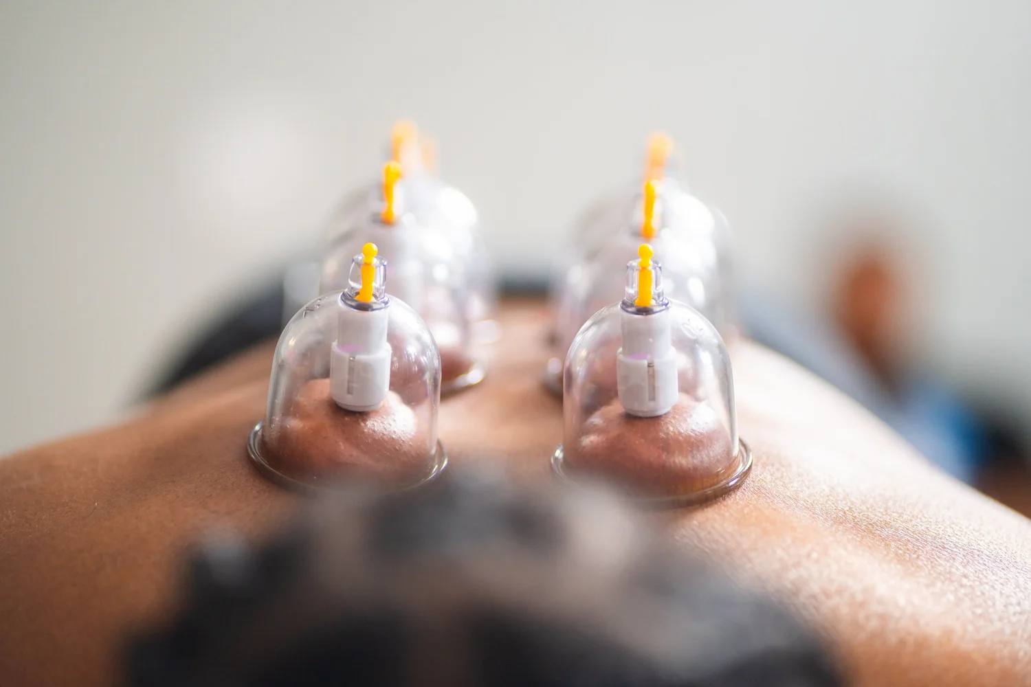 How Do Physical Therapists Use Cupping? — Wildflower Physical Therapy ...