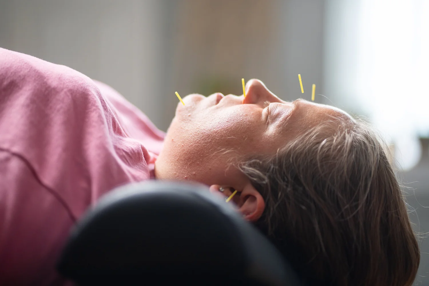 How Dry Needling Can Relieve Muscle Pain and Tension — Wildflower ...
