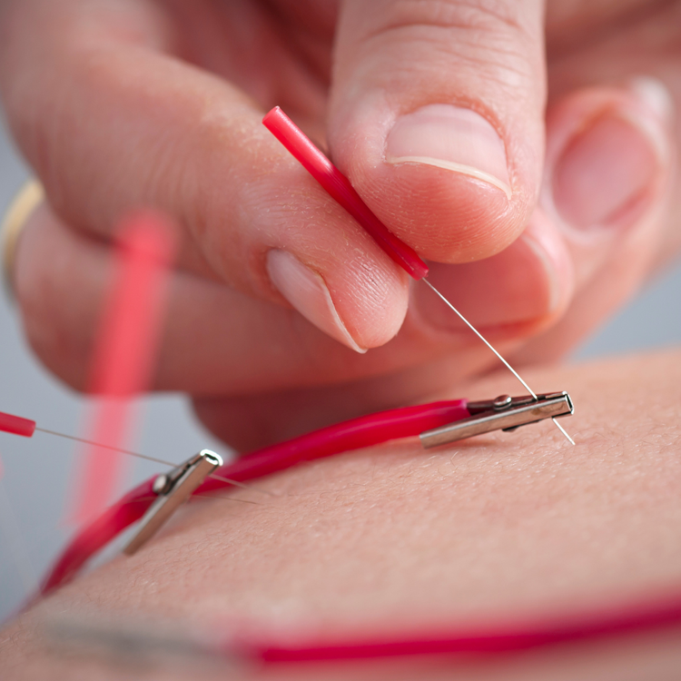 Are There Different Types of Dry Needling and How Do I Choose the Right ...