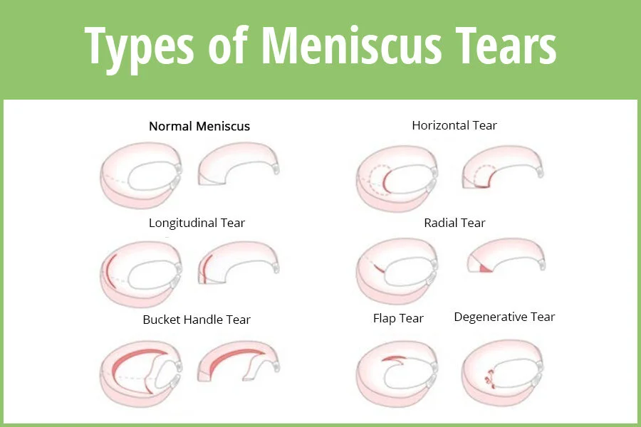 Do I Need To Address My Meniscus Tear With Surgery? — The Knee Joint