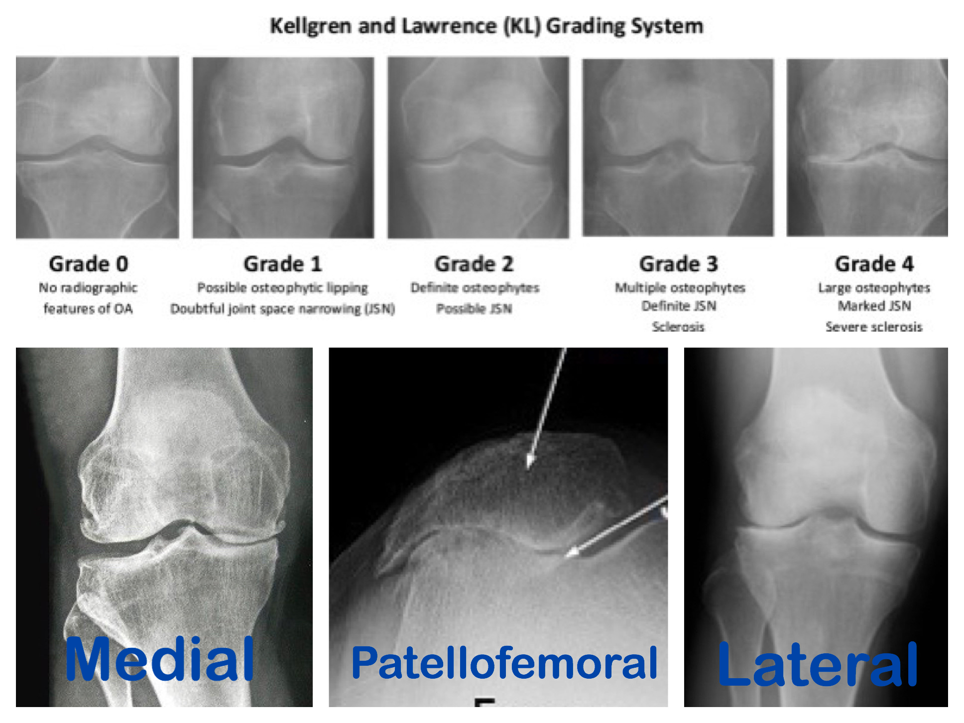 Have You Been Diagnosed With Knee Arthritis Now What The Knee Joint