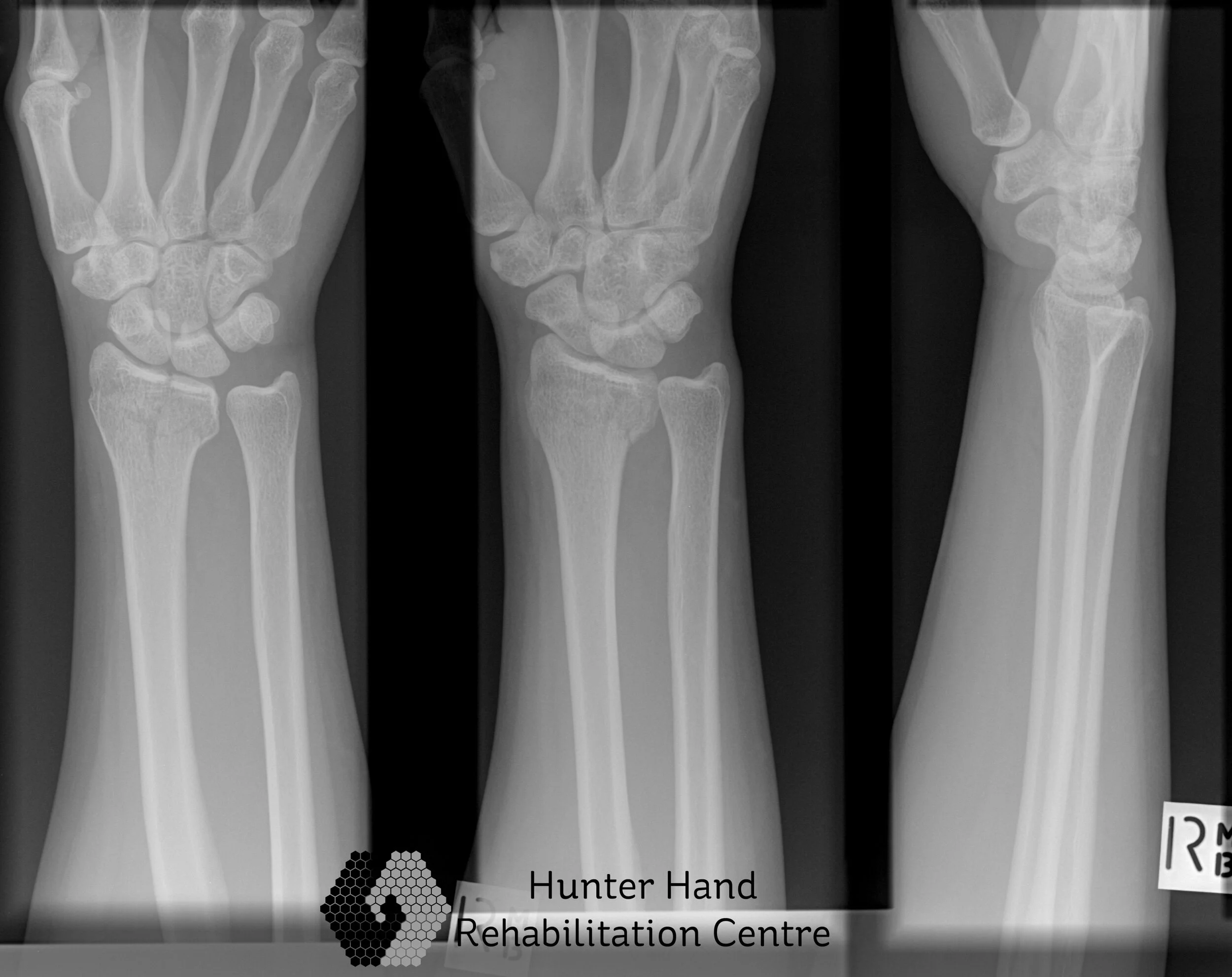 Hunter Hand Rehabilitation