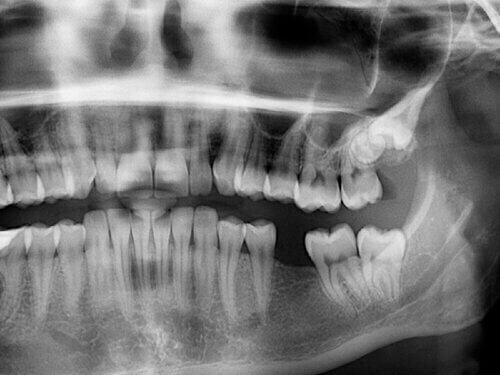 Dental Implant Care Charlotte NC | Implant Restorations & Dentistry ...