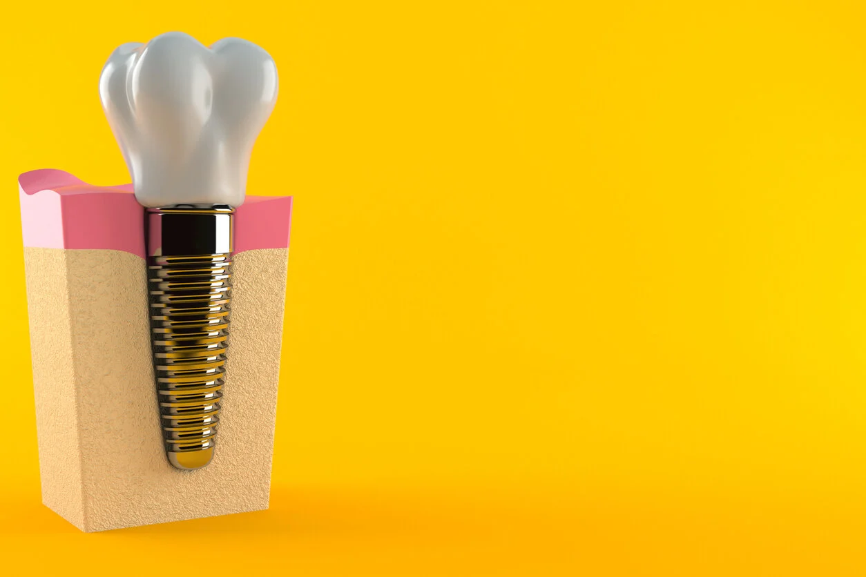 Tips for Healing After a Bone Graft — Charlotte Dental Implant Center