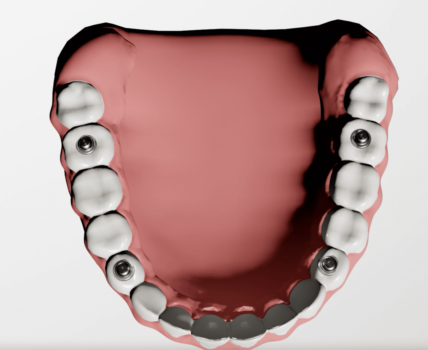 Dental Implant Care Charlotte NC | Implant Restorations & Dentistry ...