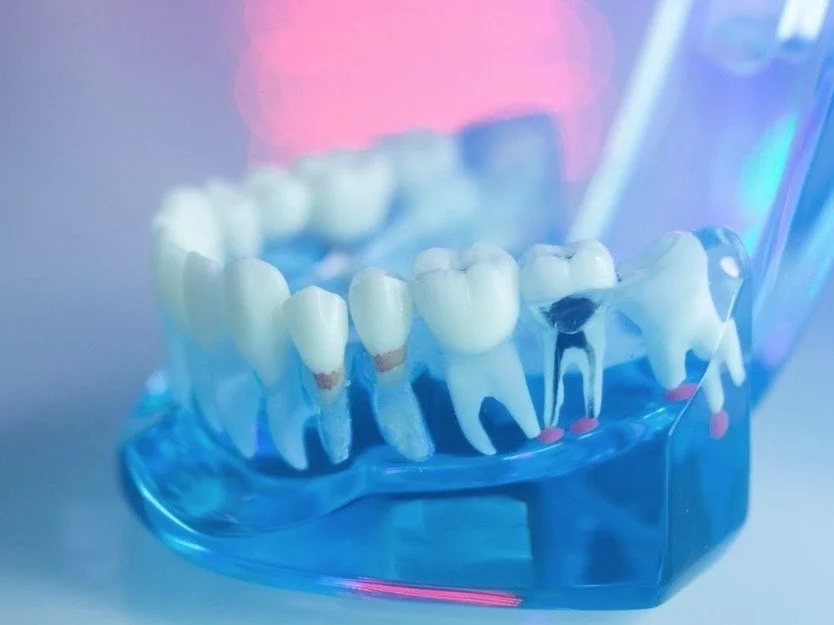 Dental Implant Care Charlotte NC | Implant Restorations & Dentistry ...