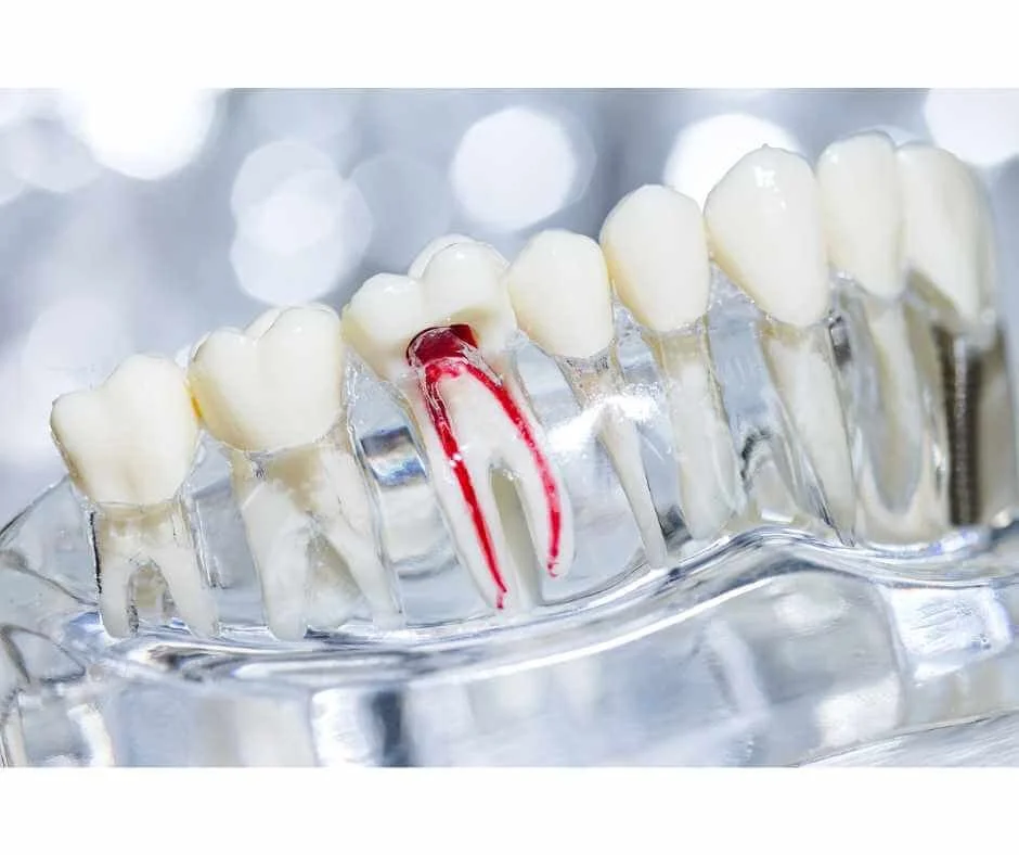 The Hidden Dangers of Root Canals: An In-Depth Look at Health Risks and ...