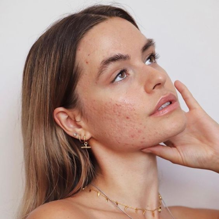 Exploring the Complexities of Acne: Understanding, Treatment, and ...