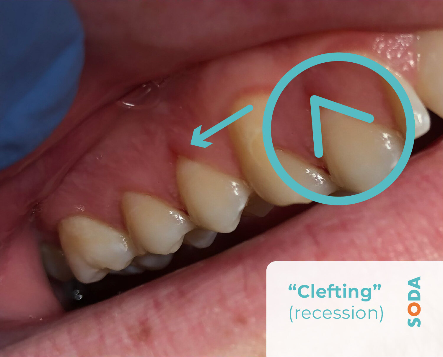 You’re Telling Me My Gums Won’t Grow Back? How Did I Do That? — SODA