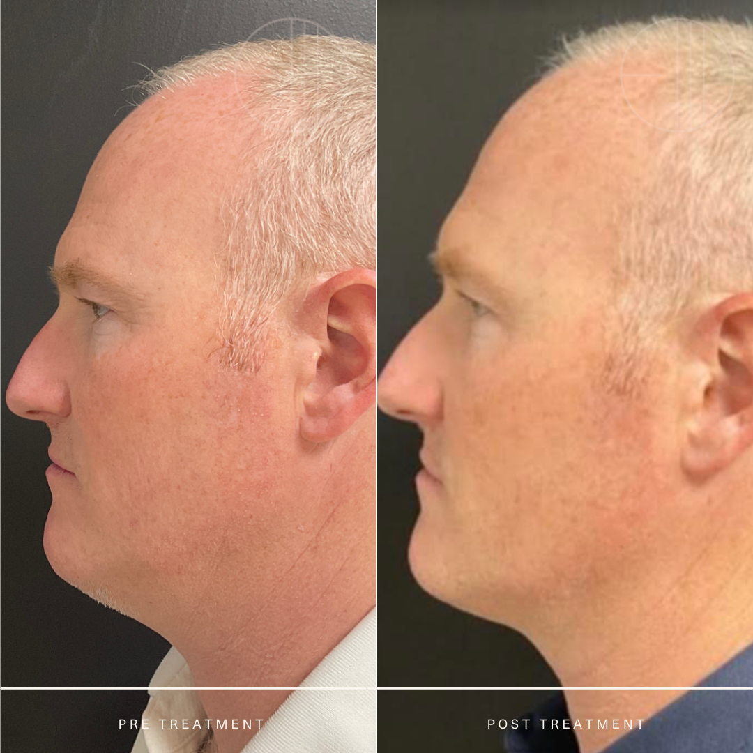 LaseMD Ultra Laser Resurfacing — Entière Dermatology