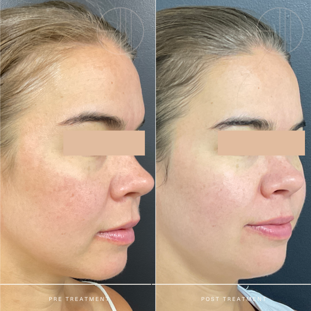 LaseMD Ultra Laser Resurfacing — Entière Dermatology