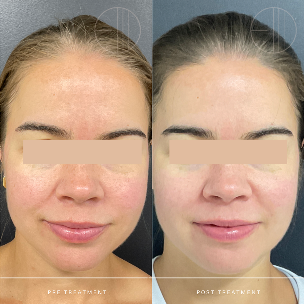 LaseMD Ultra Laser Resurfacing — Entière Dermatology