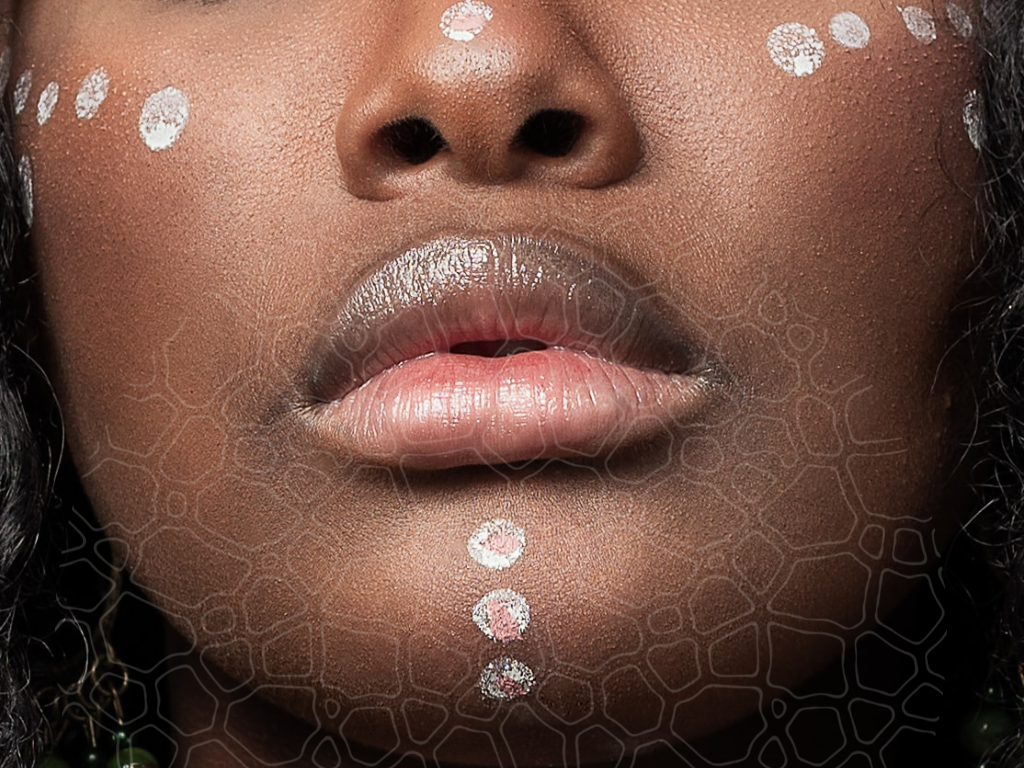 Perioral Dermatitis Lips