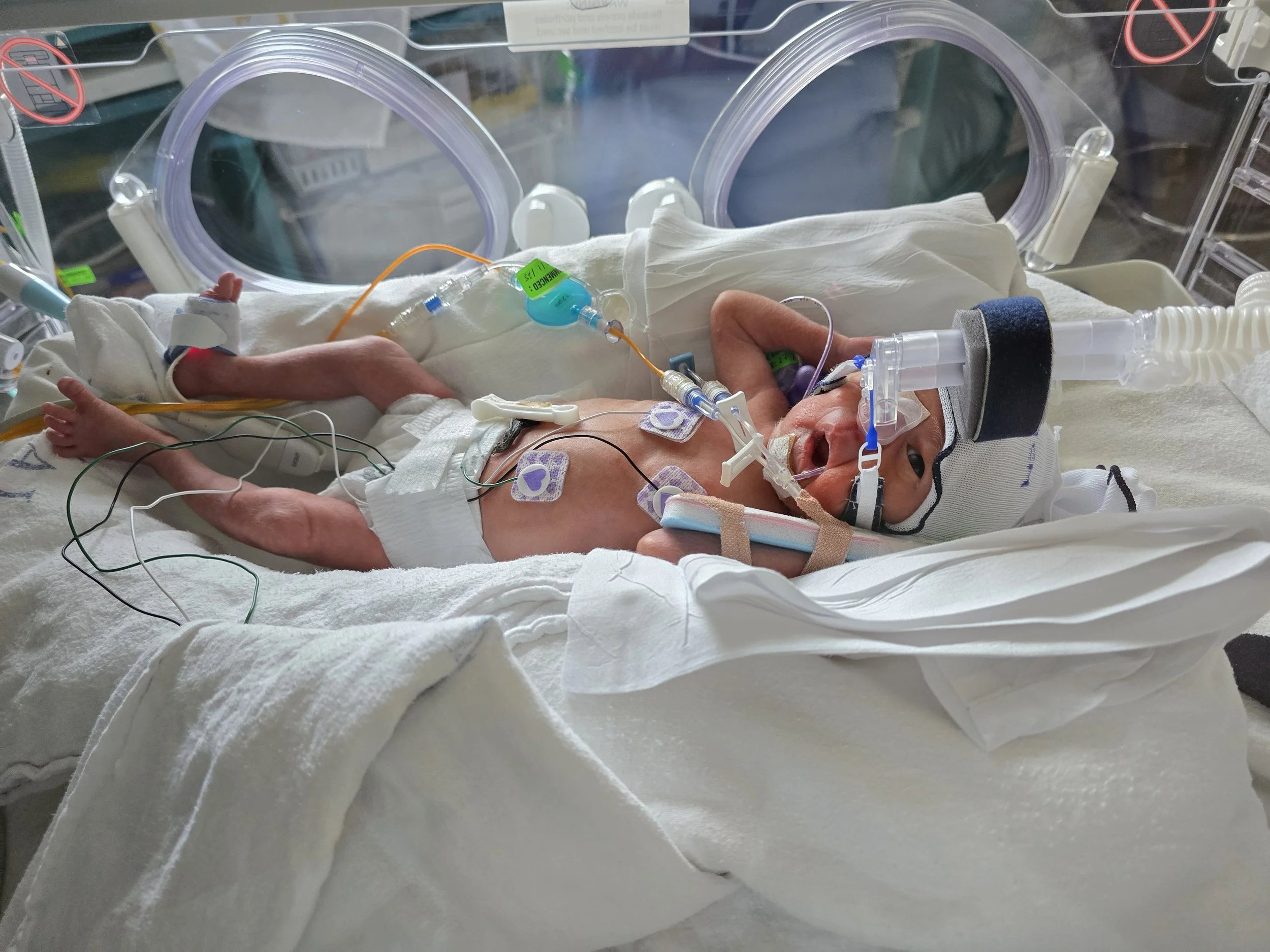 Born at 30 Weeks — Early and Unexpected, Yet Thriving Anyway — Voice ...