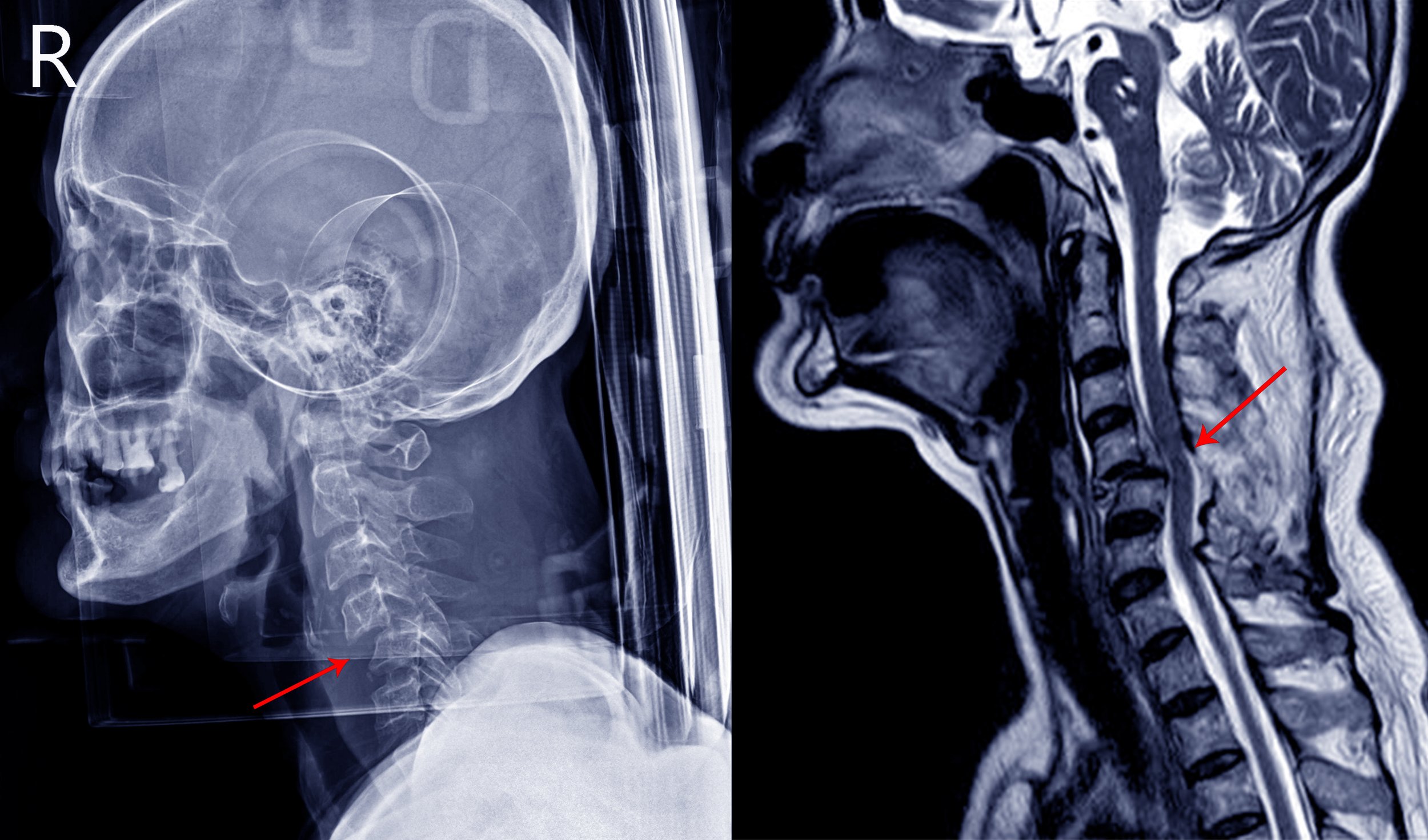 The Impact of Spinal Cord Injury on the Human Body — Anatomical Concepts
