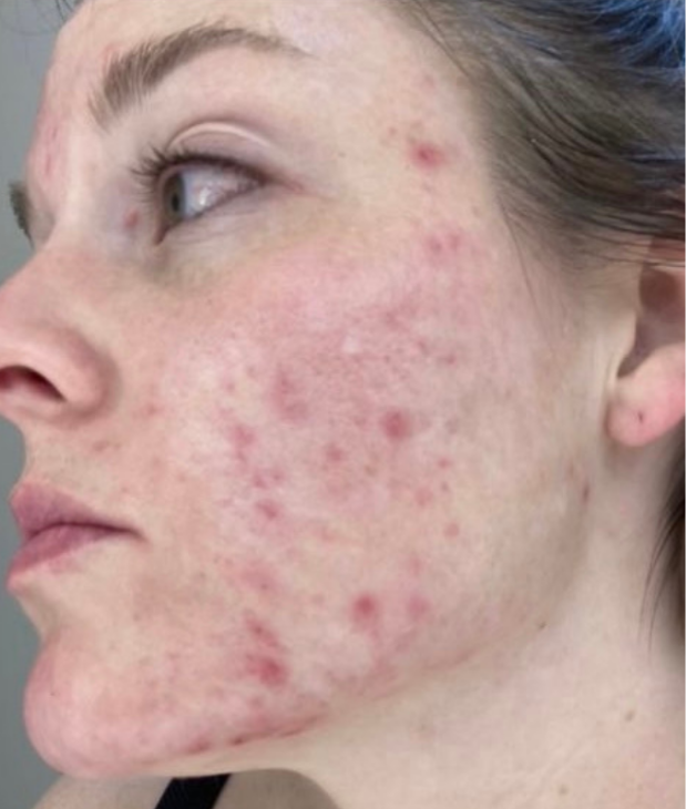 Results from the Clear Skin Lab — The Clear Skin Lab