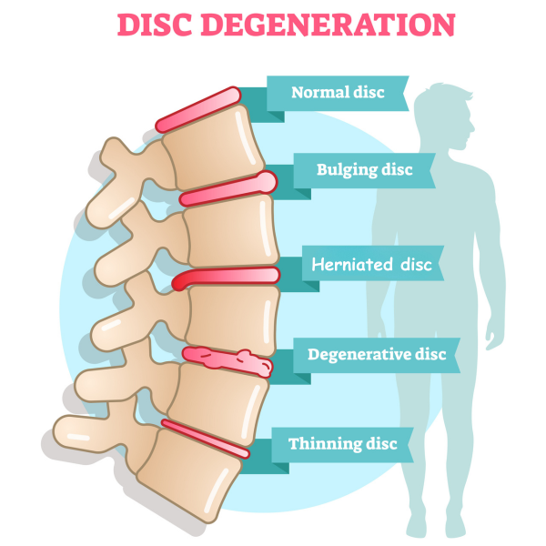 Spinal Disc Degeneration — Believe