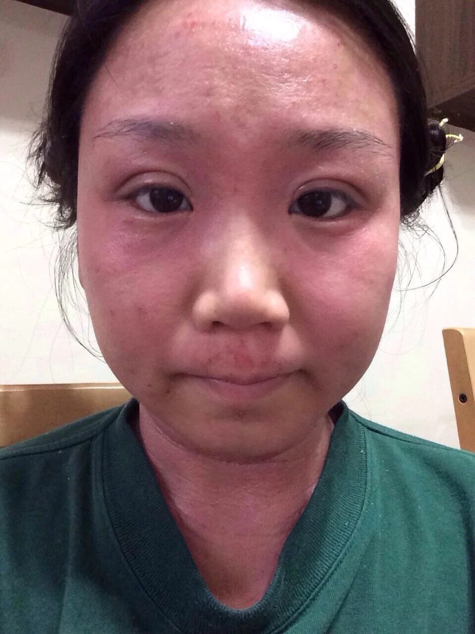 Stages of Skin Healing — Decoding Topical Steroid Withdrawal