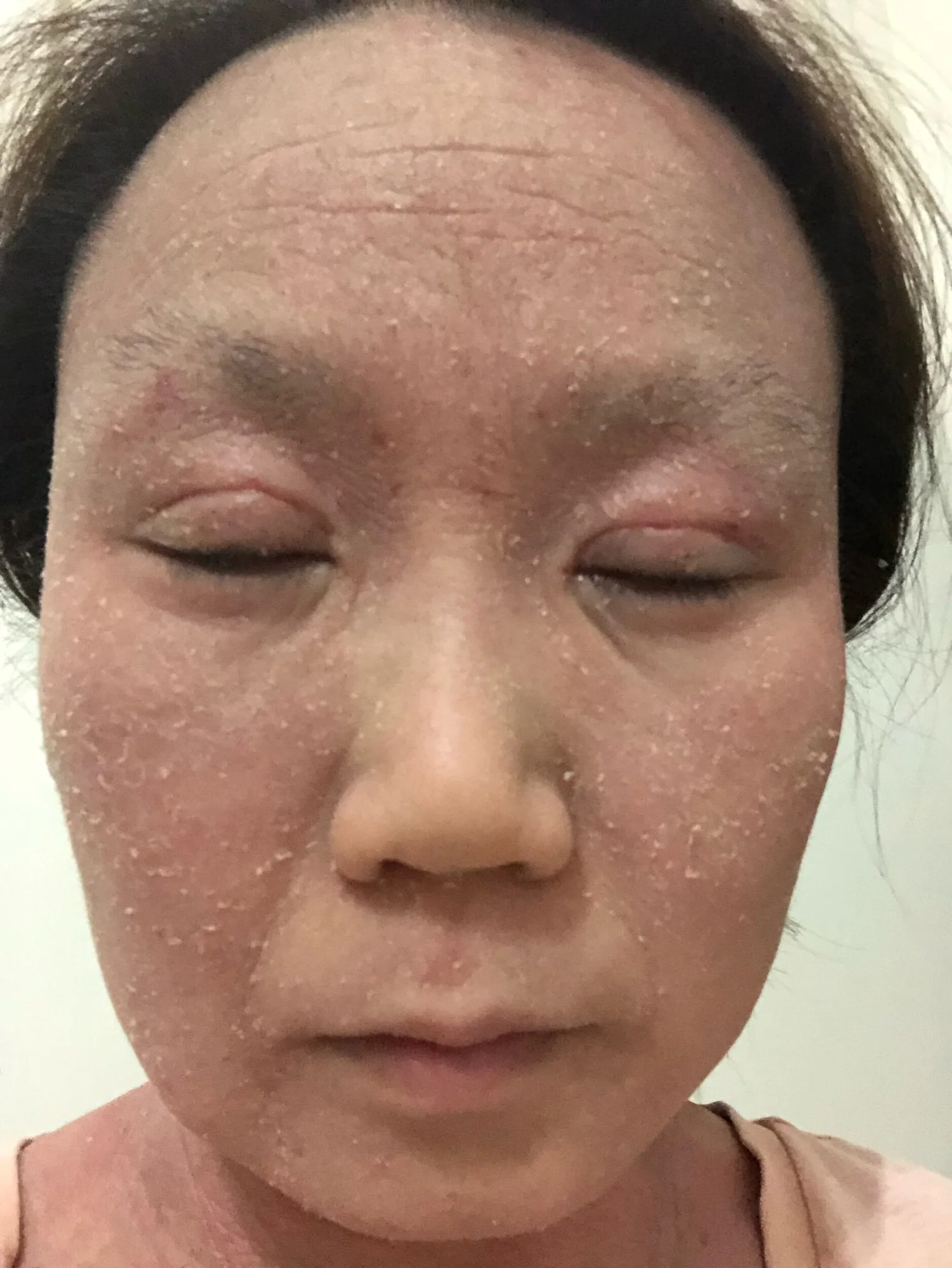 Stages of Skin Healing — Decoding Topical Steroid Withdrawal